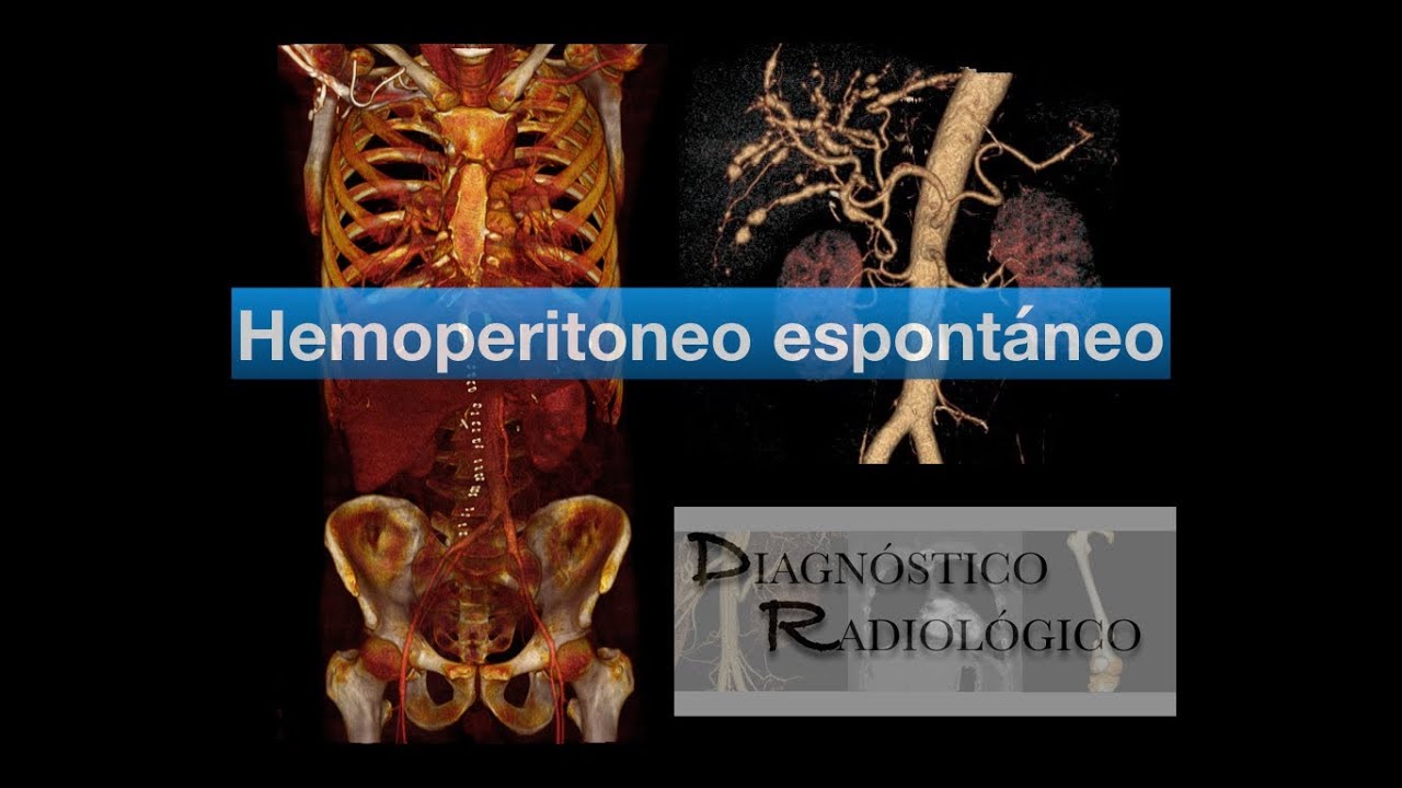 Evaluación Radiológica del Hemoperitoneo no traumático » casiMedicos TV