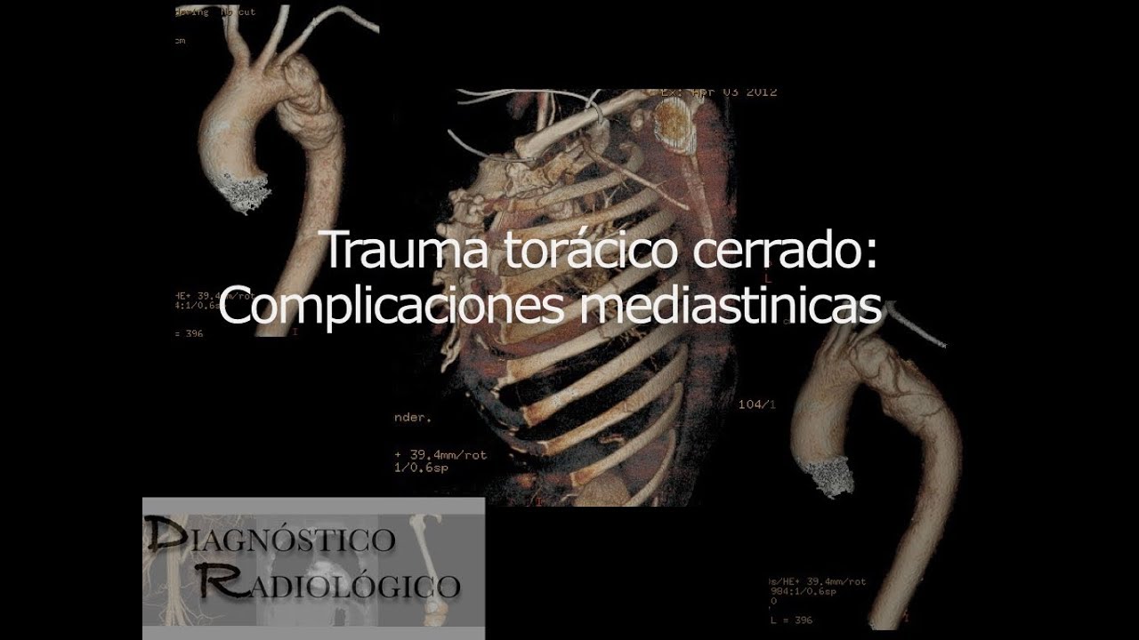 Trauma torácico cerrado » casiMedicos TV